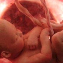 Placenta Humana Comer Placenta Humana, Una Práctica Que Cobra Fuerza